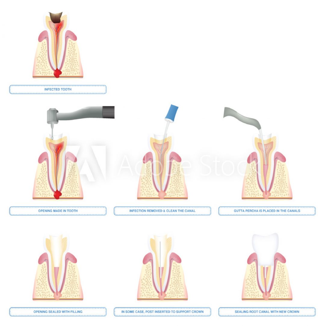 pasos endodoncia-01 - Clínica Dental Roca Santiago