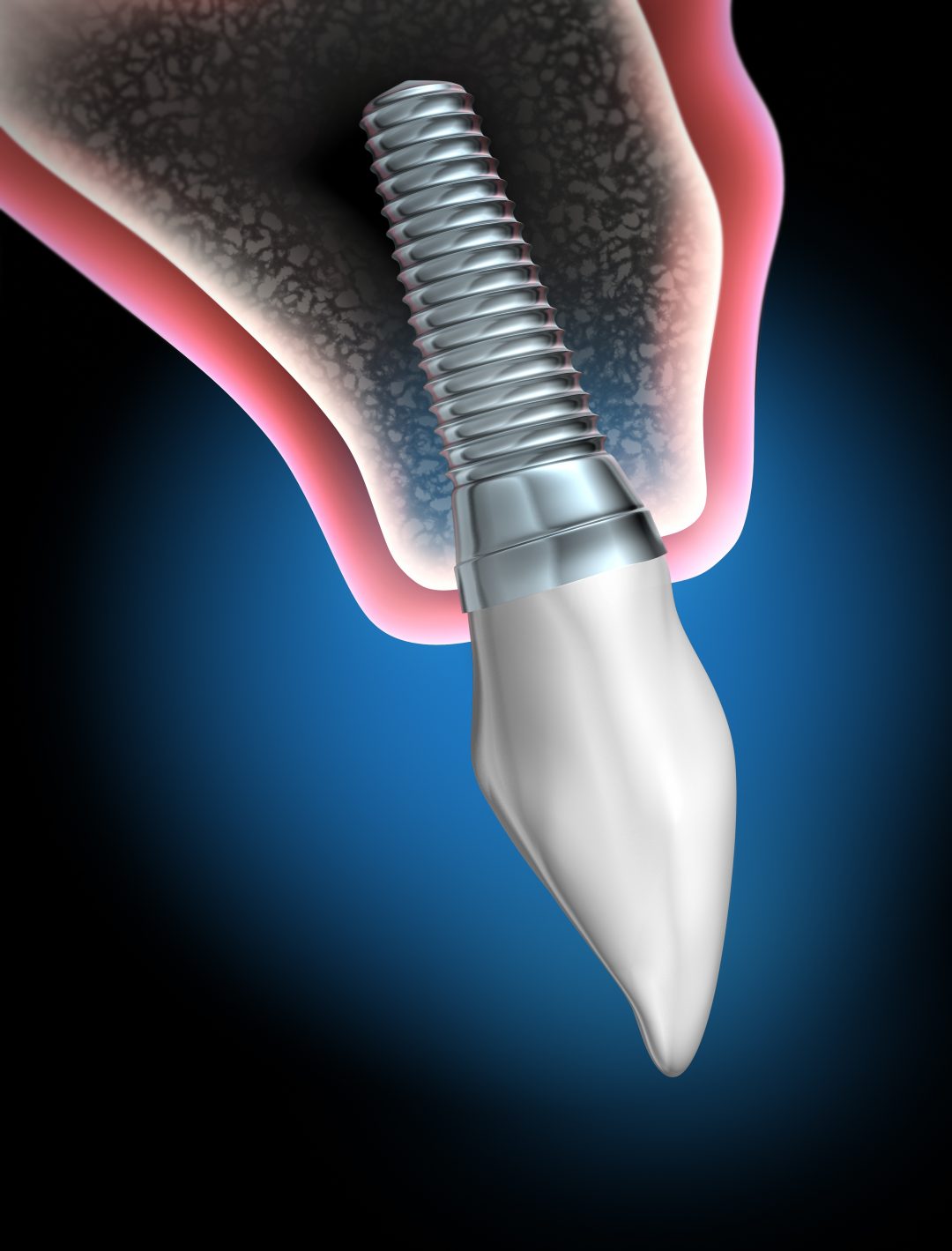 Immediate implants - Clínica Dental Roca Santiago